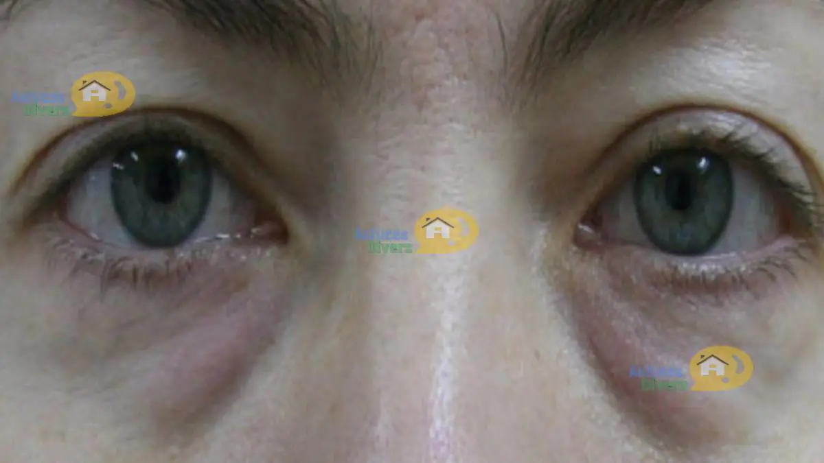 Les Cernes Sous les Yeux: 6 Astuces Efficaces pour les éliminer