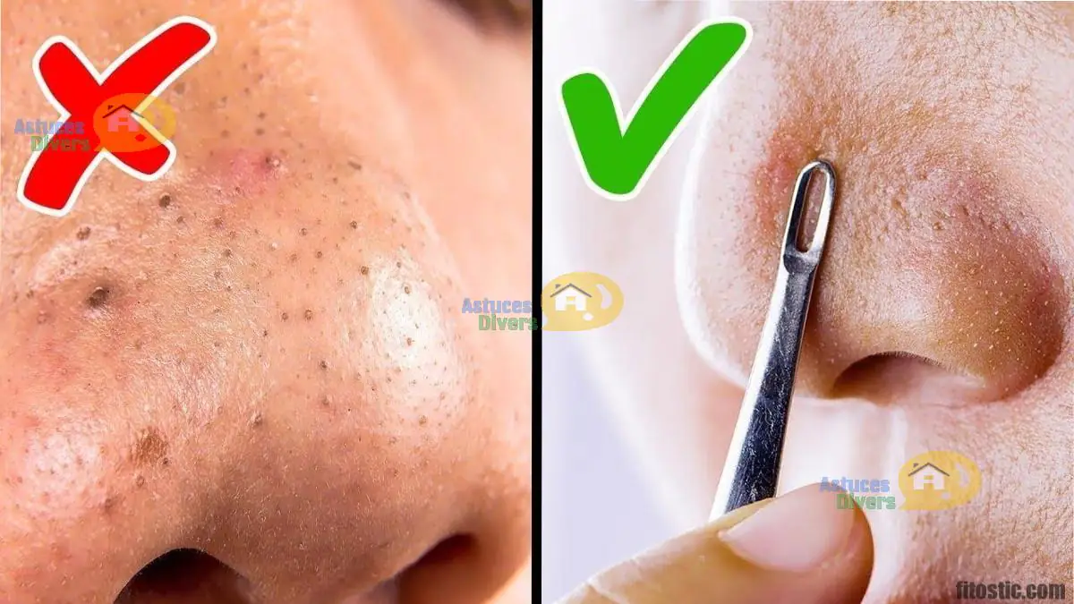 7 Astuces naturelles et efficaces anti-points noirs